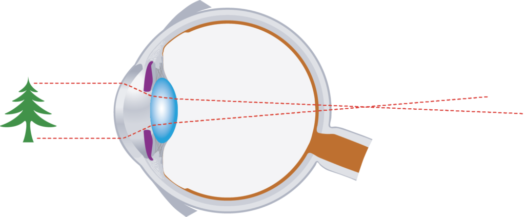Comment voit un hypermétrope ? - Potentiel Vision