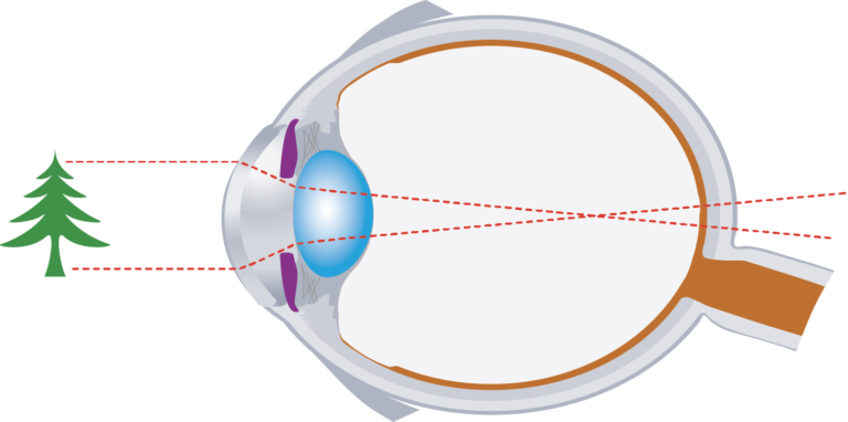 Comment voit un hypermétrope ? - Potentiel Vision