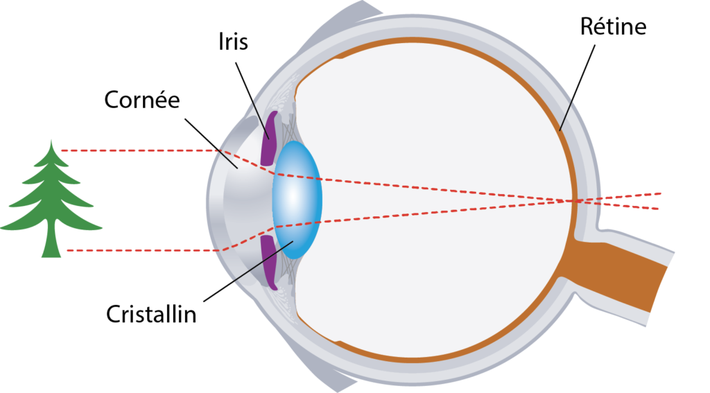 Comment voit un hypermétrope ? - Potentiel Vision